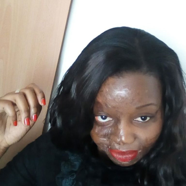 Acid Attack Survivor Reveals How She Learned to Love Herself Again ...